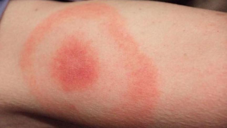 Maladie de Lyme : deux Chablaisiennes racontent leur combat - La Savoie